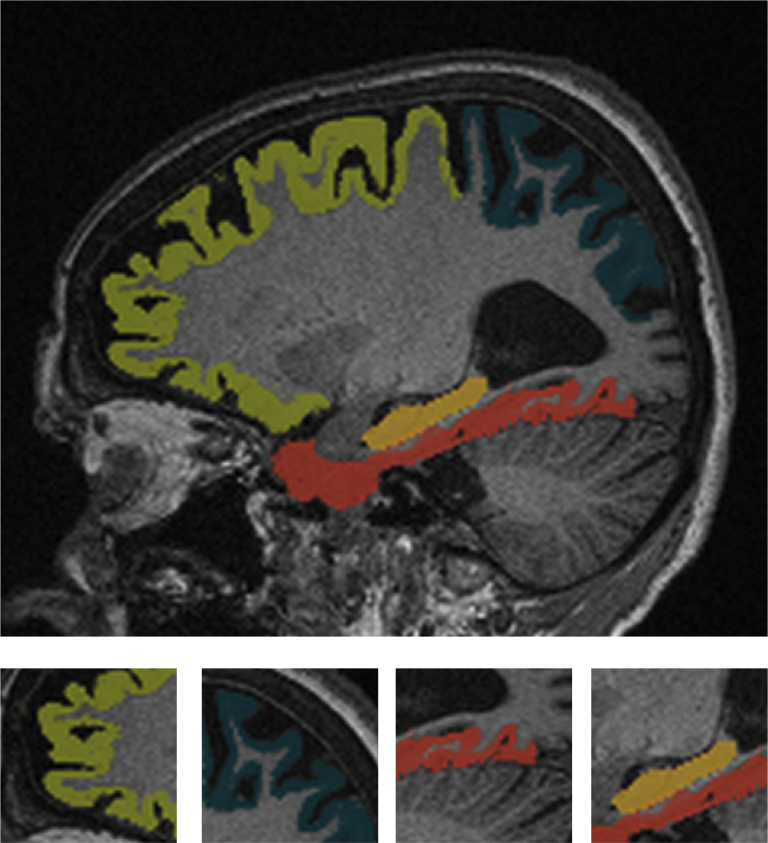 Software van Icometrix voor diagnose van dementie - Made in